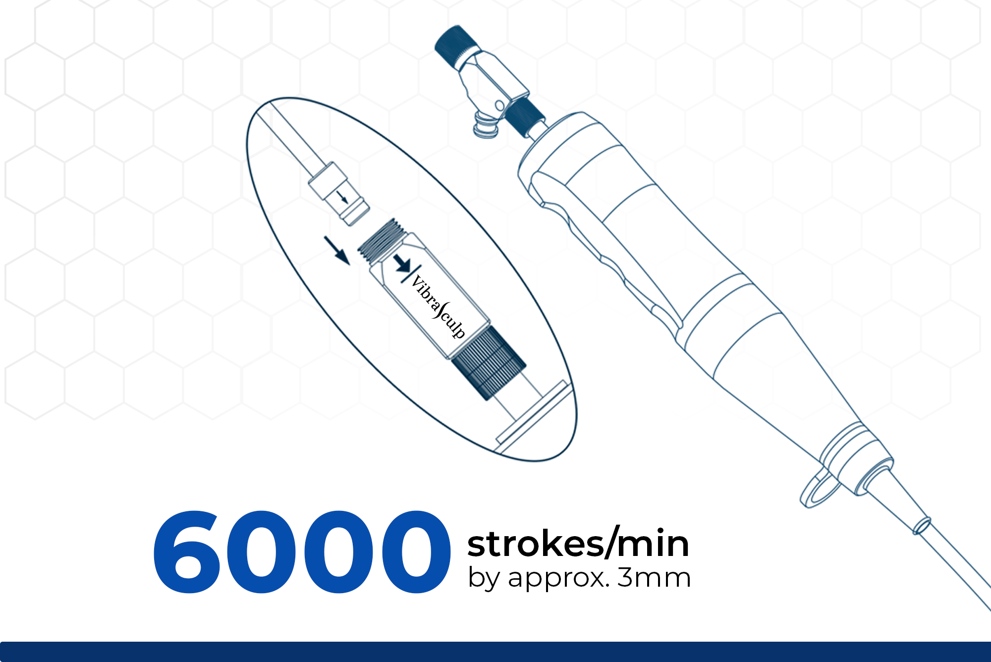 VibraSculp – Power Assisted Lipoplasty Device